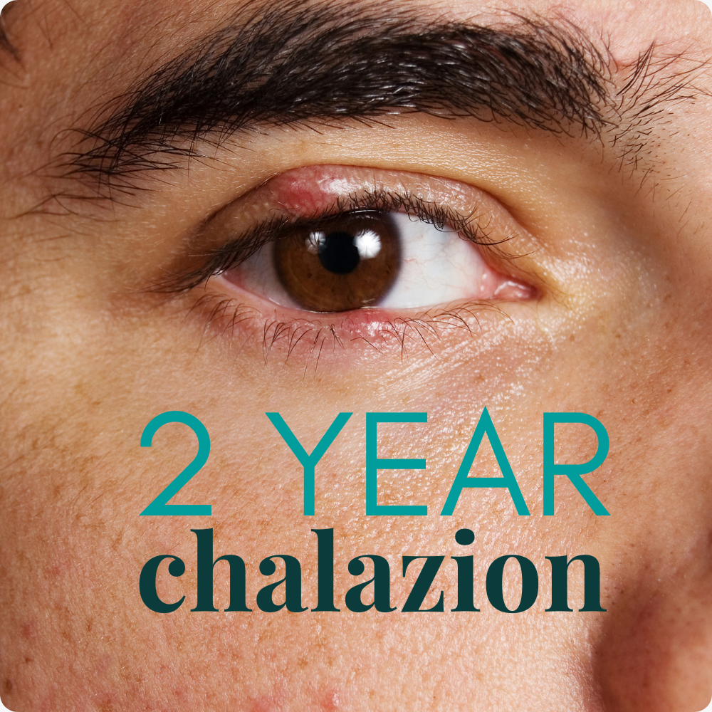2 Year Old Chalazion Treatment: 3-Step Protocol with Focused Eye Roll ...