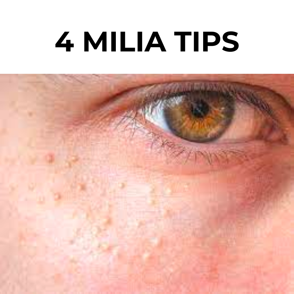 4 MILIA TIPS – We Love Eyes