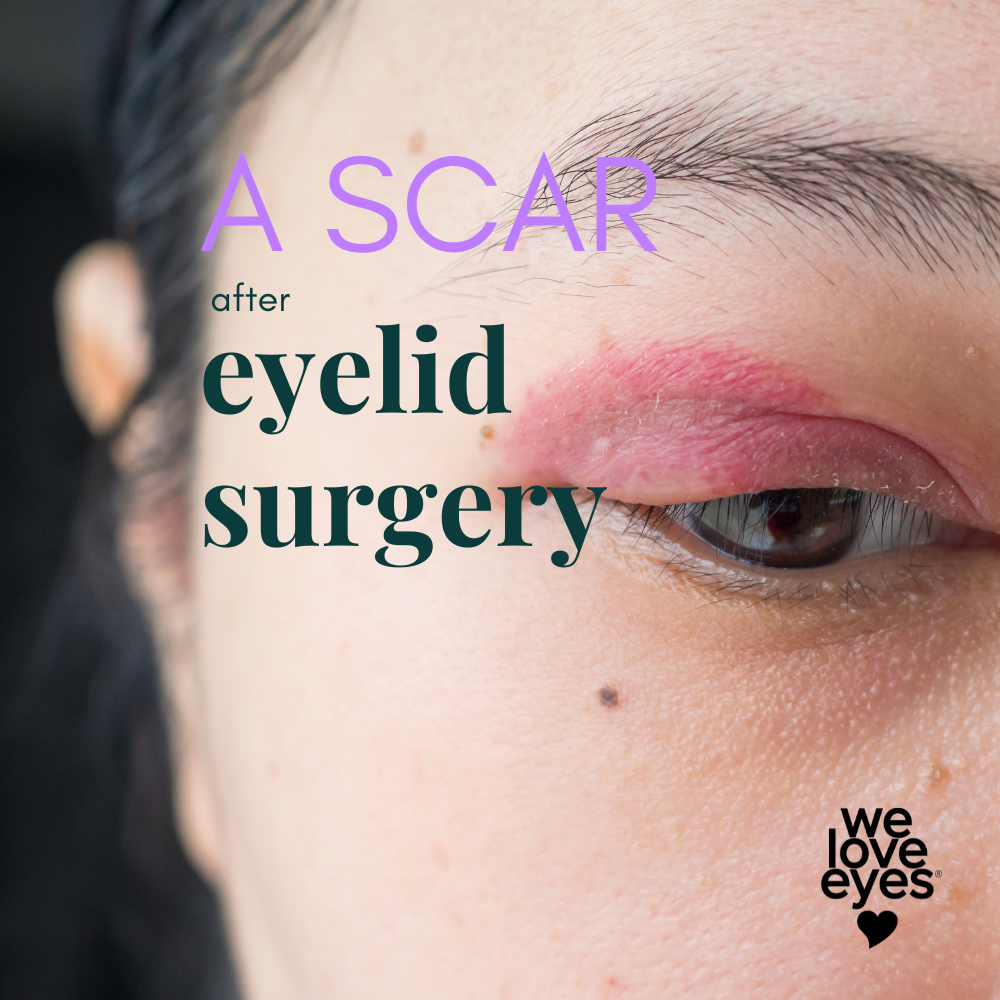 FAQ: Scar on the Inside Eyelid After Stye Surgery, Includes Video – We ...