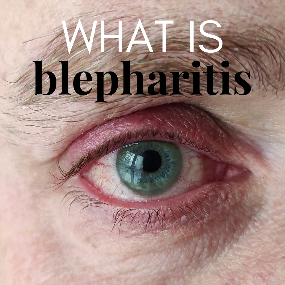 Blepharitis 101: Your Comprehensive Guide to Eyelid Inflammation & We – We Love Eyes