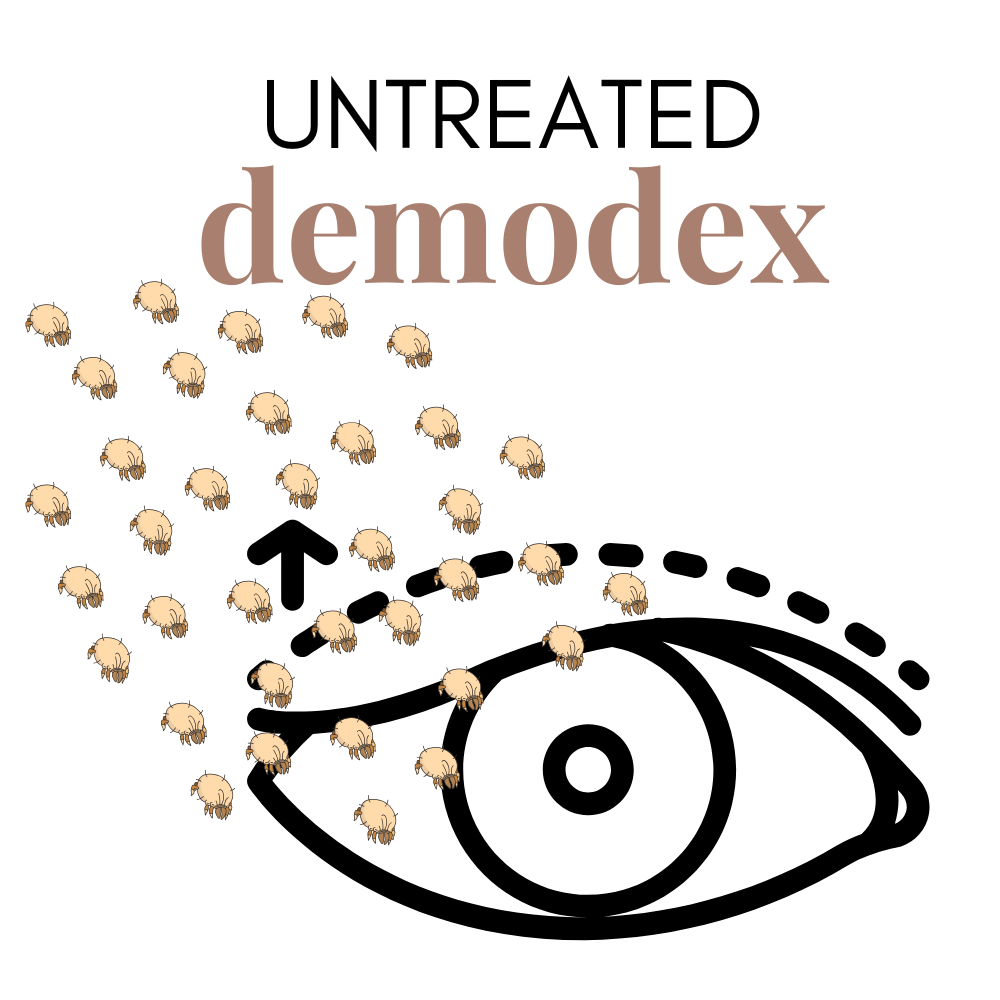 What Happens When You Leave Demodex Mites Blepharitis Untreated? Risks ...
