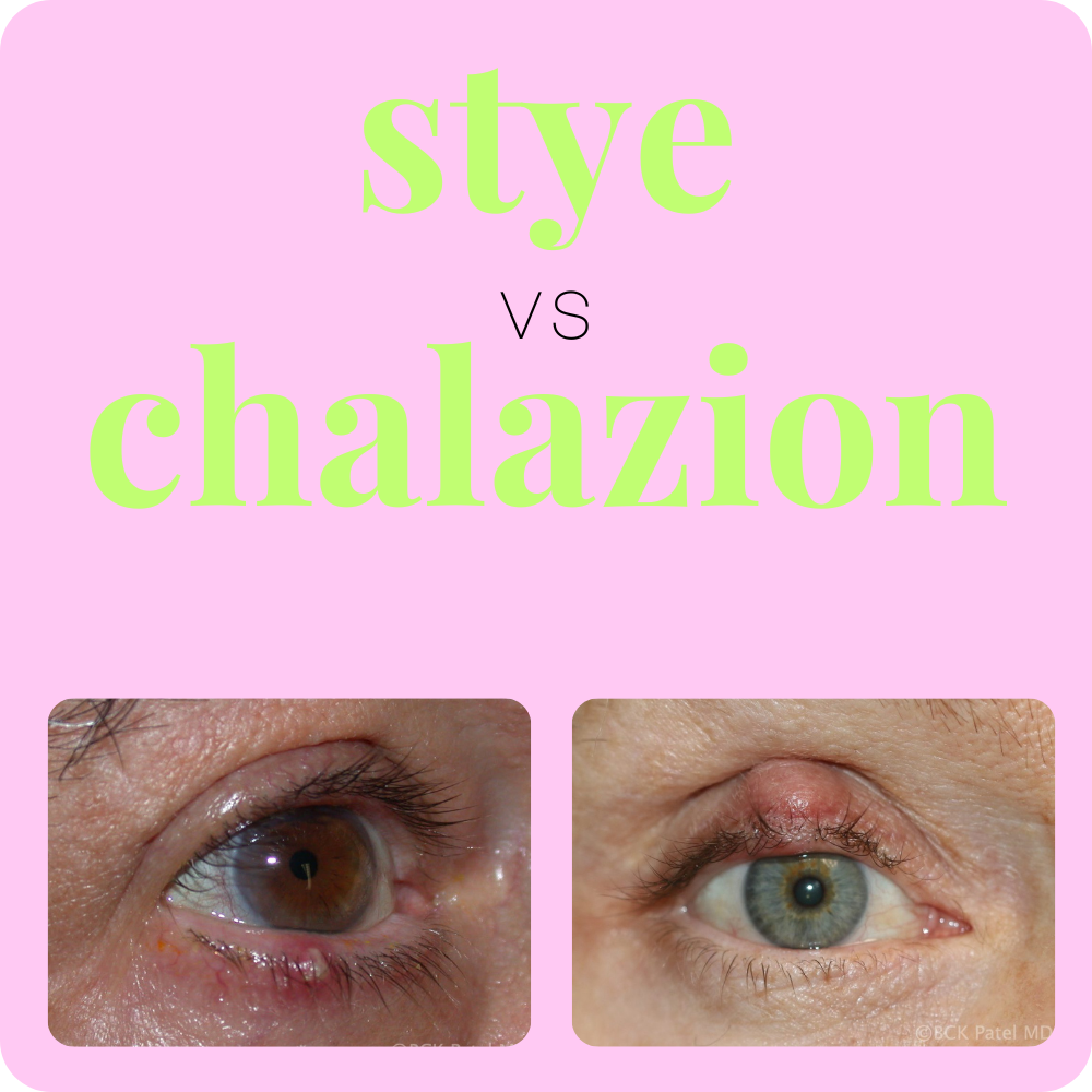 stye chalazion difference